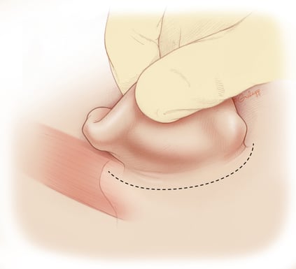 Tympanoplasty: Eardrum Repair, Indications, Techniques, and Recovery Guide