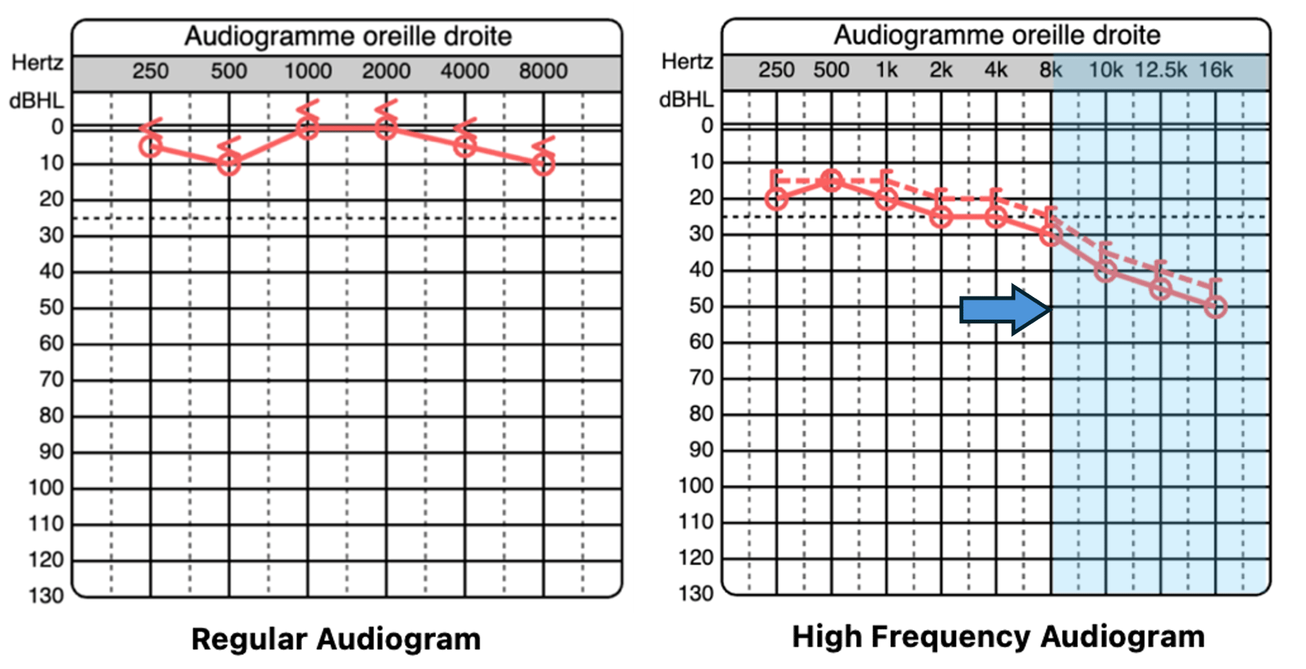 High Frequency Audiometry | Understanding the Importance