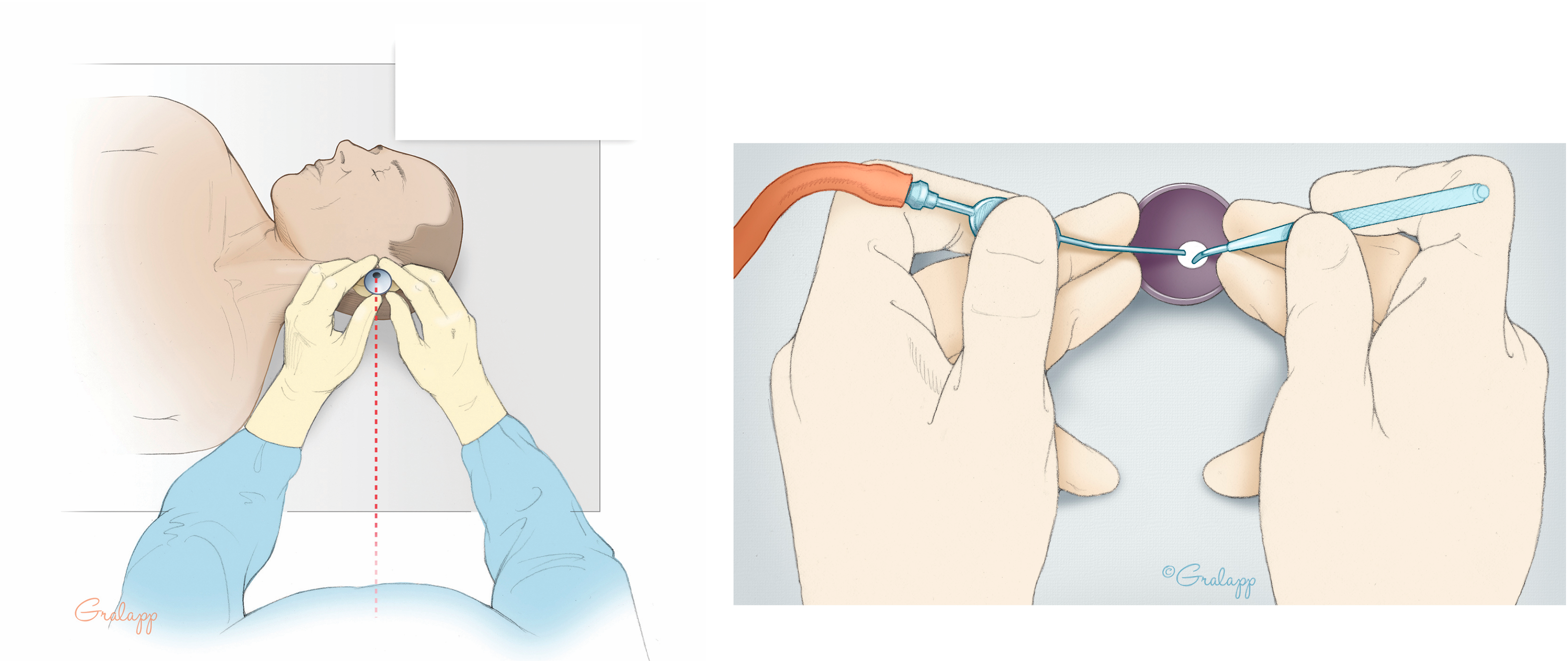 Tympanoplasty: Eardrum Repair, Indications, Techniques, and Recovery Guide