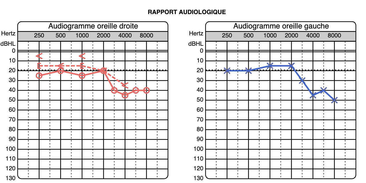 Guide complet pour comprendre les audiogrammes | Perte Auditive