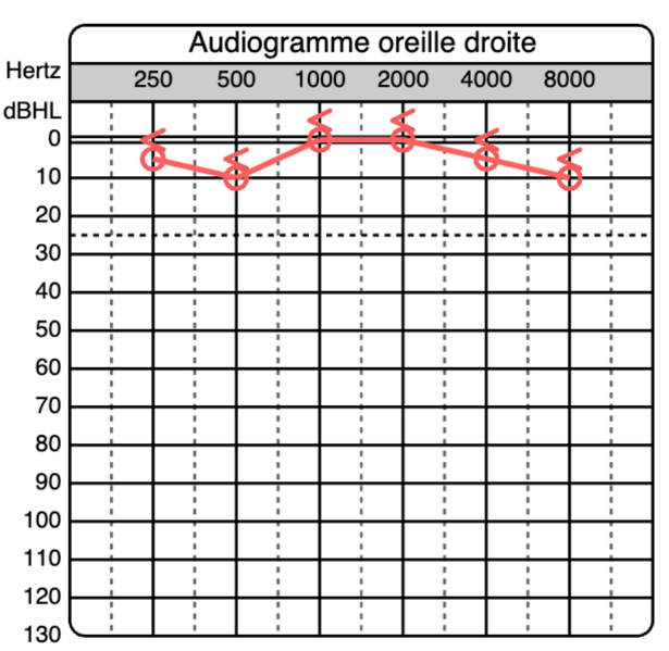 Guide complet pour comprendre les audiogrammes | Perte Auditive