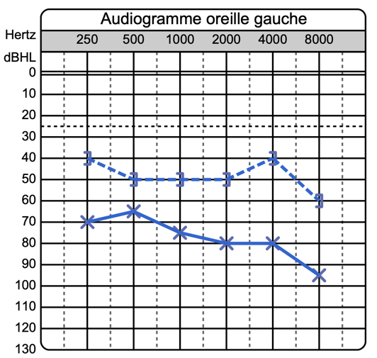 Guide complet pour comprendre les audiogrammes | Perte Auditive