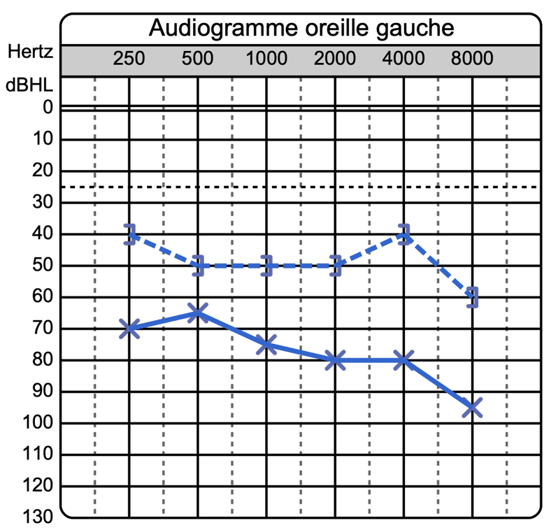 Guide complet pour comprendre les audiogrammes | Perte Auditive