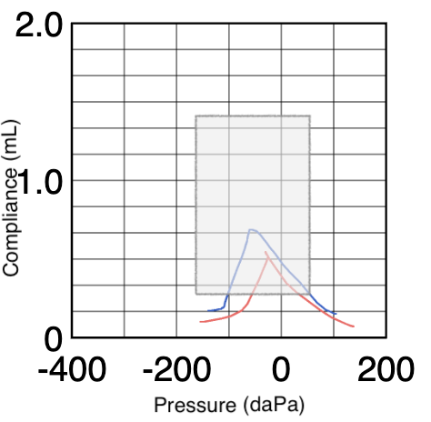 Tympanometry Explained | How to interpret results | ODYO