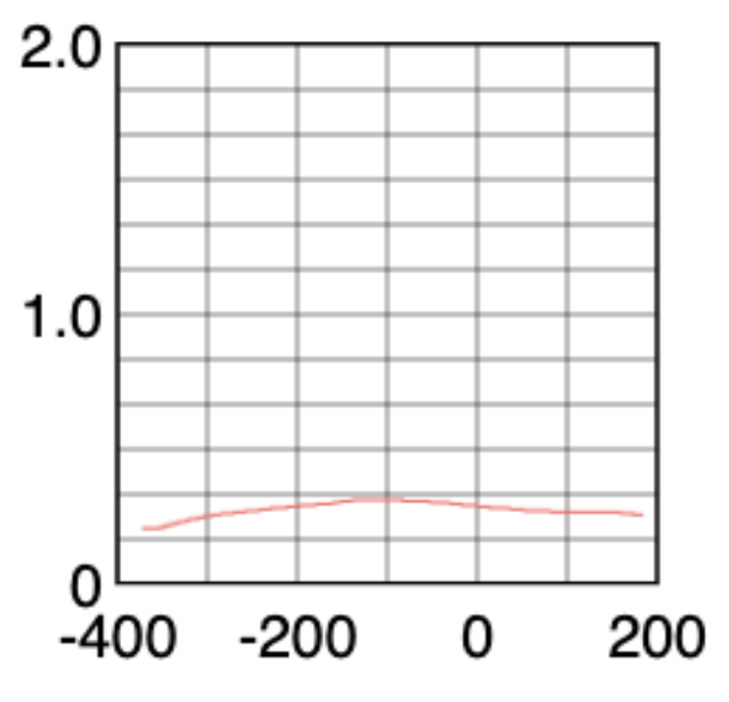 Tympanometry Explained | How to interpret results | ODYO