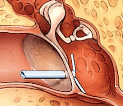 Myringotomy and Ear tubes: Procedure, Benefits, Risks, and Aftercare