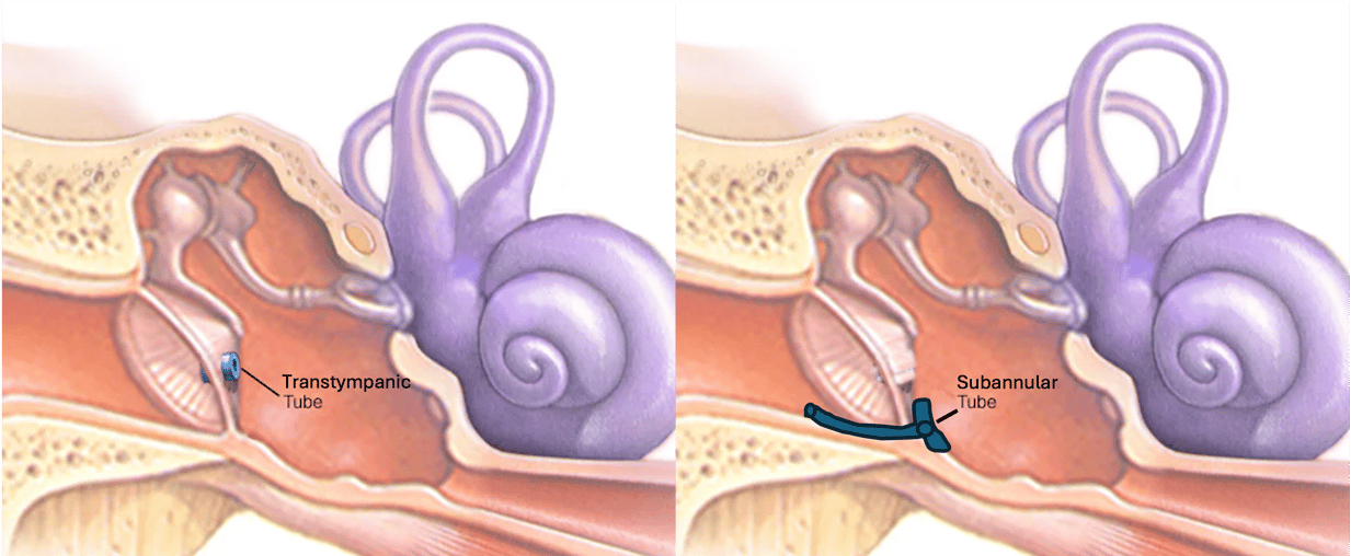 Subannular ear tubes: A permanent solution to solve chronic ear problems