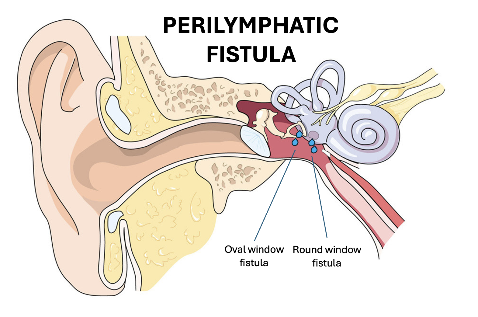 Perilymphatic fistula repair: Understanding the surgery, expectations ...