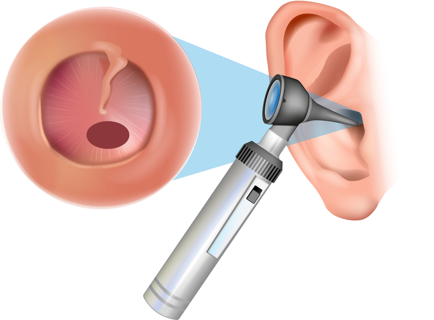 Tympanoplasty: Eardrum Repair, Indications, Techniques, and Recovery Guide